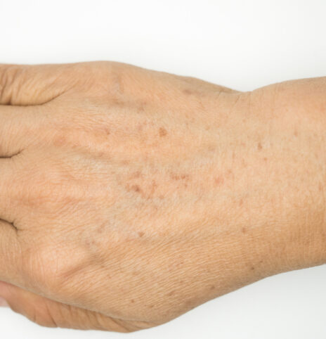Tâches sur les mains - Clinic B